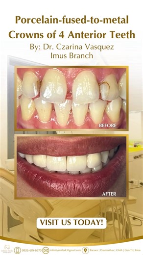 Gap in the front? Cavity drama on the side tooth? 😬 We fixed it with root canal treatment and finished strong with PFM crowns—bringing back function, confidence, and a smile worth showing off! E-max was the dream, but we made a smart, beautiful solution that fit the budget—expertly done by Dr. Czarina Vasquez. Because great smiles don’t have to break the bank! Message: https://m.me/InfinitySmileDentalClinic/ 📞: 0926-619-6970 📧: infinitysmiledc@gmail.com 📍Bacoor | Dasmariñas | GMA | Gen Tri |