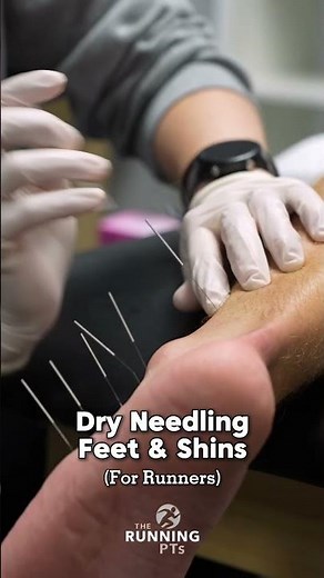 Dry Needling for Runners’ Foot & Shin Pain | The Running PTs