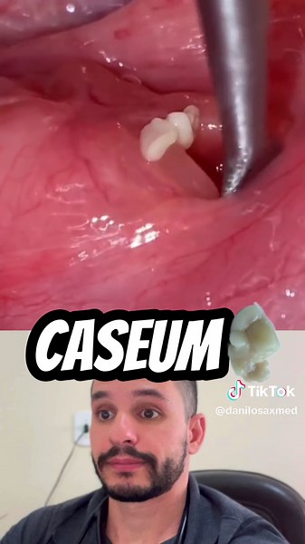 Como identificar e tratar o caseum na garganta