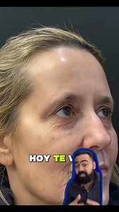 Rejuvenece tu rostro con este botox natural efectivo | Ideas y más.