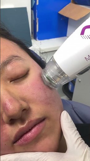 Matrix Pro RF Microneedling