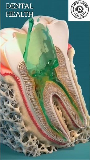 3D RCT Animation Explained | How Root Canal Treatment Saves Your Tooth