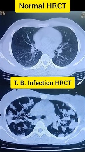 Normal HRCT 🆚 Abnormal HRCT