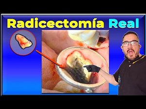 Radicectomy or Root Amputation: The Last Dental Resort