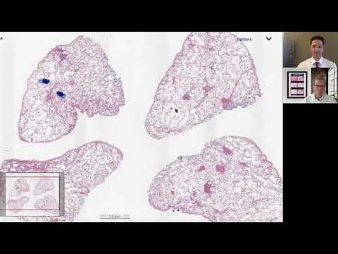 Pulmonary Veno-Occlusive Disease (PVOD) - Deep Dives in Pulmonary Pathology