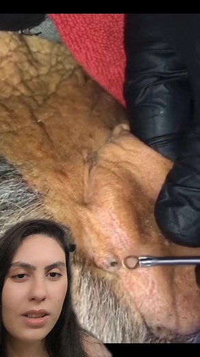 São tantos cravos de tantos tamanhos #cravo #cravos #espinhas #acne #acné #komedo #pele #pelesaudavel #espinha #cravosgigantes #cravoseespinhas #confortable #terapia #reaction #reagindo #react #dermatologist #dermatologo #estetica #satisfying #satisfatório #satisfatorio #removal #limpezadepele #limpezasatisfatoria #limpezadecravos #limpiezafacial #pimple #fly #foryou #foryoupage #viral #virall #viraliza