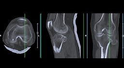 Knee Joint CT-Scan Revealing Tibial Fracture: The scan highlights a...