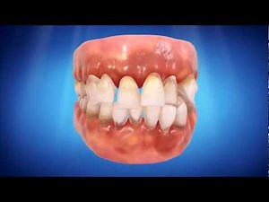 Invisalign Tooth Straightening Healthy Teeth