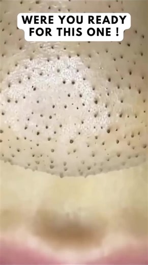 Amazing Pimple Popping Out NOW.😱😢 | Skating Fairy Rolls