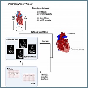 Untreated hypertension silently damages The heart! 💔 🔍 Macrostructural Changes: 1️⃣ Left Ventricular Hypertrophy (LVH): Thickened heart muscle → #1 predictor of heart failure and sudden death. 2️⃣ Atrial Remodeling: Stretched left/right atria → disrupts blood flow and rhythm. ⚡Functional Abnormalities: Heart Failure: Both systolic (weak pumping) and diastolic (stiff heart). Arrhythmias: Higher risk of atrial fibrillation➡️ stroke risk! and ventricular arrhythmias. Conduction Issues: Delays and