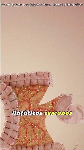 Colorectal Cancer Surgery Explained (3D Animation) #cancer #surgery #colon #recovery #3danimation