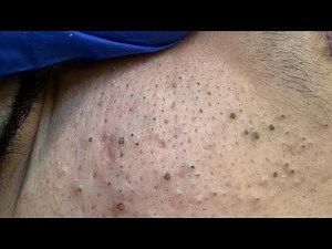 [ASMR] Deep Cleansing Techniques for Acne, Whitehead & Blackhead Removal