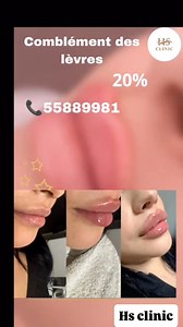 💋 Des lèvres plus pulpeuses, plus harmonieuses. Profitez de –20% sur le comblement des lèvres chez HS Clinic 💉✨ 📞 55 88 99 81 – Réservez votre séance dès maintenant. | HS Clinic