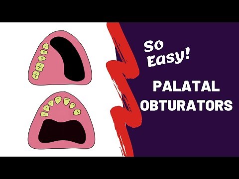 PROSTHODONTICS | What is Palatal Obturator?