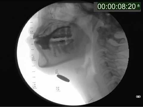 Videofluoroscopia normal.m4v