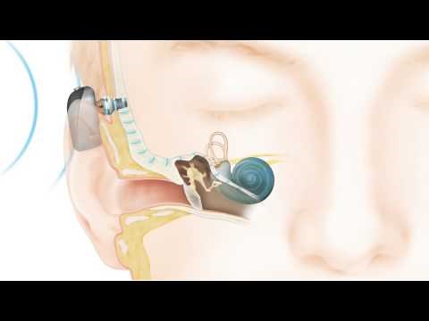 How the Baha Connect System works