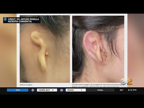 Woman receives 3D-printed ear made of human cells