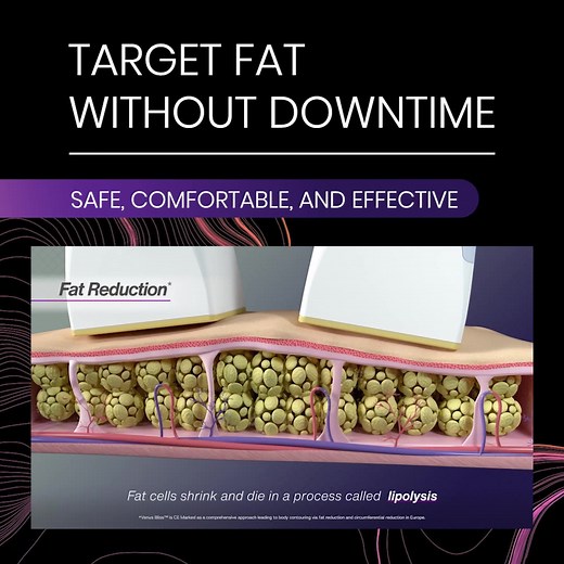 The Venus Bliss MAX™ is your advanced 3-in-1 solution for non-invasive body contouring. Harnessing the power of diode laser, radio frequency, and muscle stimulation technologies, Venus Bliss MAX™ targets stubborn fat and tightens skin simultaneously. | Venus Aesthetic Intelligence