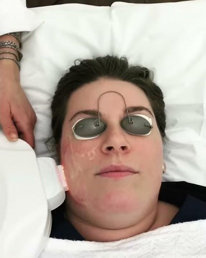 Live Intense Pulsed Light (IPL) Treatment