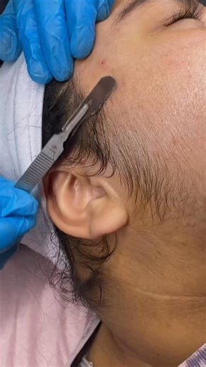 El dermaplaning es un tratamiento facial no invasivo que exfolia suavemente la piel, eliminando células muertas y vello facial superficial para revelar un rostro más liso, luminoso y uniforme. Mejora la textura, potencia la absorción de activos cosméticos y deja un acabado inmediato tipo piel de porcelana. ✨ 📍Culiacán 135 Col. Rodríguez Reynosa, Tamaulipas 📲 Informes y citas al 8995052031 por WhatsApp o DM. ⭐️⭐️⭐️⭐️⭐️ Más de 100 reseñas en Facebook y Google #spa #viral #relajacion #reynosa #sk