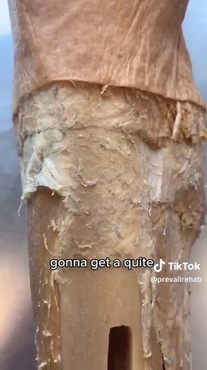 Understanding Shin Splints: Anatomy, Causes, and Relief