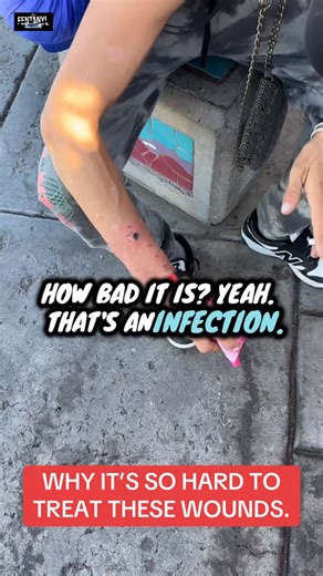 The Fentanyl Project on Instagram: "This is why these wounds are so hard to treat. It’s not just the wound. It’s the substance. It creates intense pain signals, uncontrollable movement, and body jerking. People can’t stay still long enough for proper cleaning or care. Bandages won’t stay on. Healing can’t begin. This isn’t a lack of willpower. It’s chemistry overriding the nervous system. These wounds don’t heal with just antibiotics. They heal with stability, medical support, and sobriety. Educ
