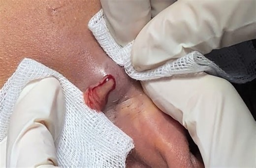 Cyst on Parotid Region Incision and Drainage