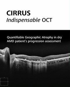 With Advanced RPE Analysis, ZEISS CIRRUS offers qualitative and quantitative Geographic Atrophy analysis results for your dry AMD patients. Explore ZEISS OCT solutions: https://zeiss.ly/fb-CIRRUS02 #ZEISSmeditec #ophthalmology #OCT *Not all products/services are available in all countries. | ZEISS Medical Technology