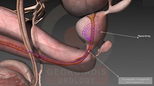 Everything about Chronic Prostatitis | Georgiadis Urology