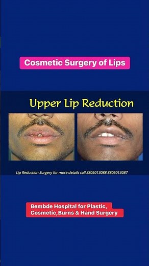 Lip Reduction or Lip Rejuvenation or Cheiloplasty Cosmetic Surgery for Reshaping of Thick Bulky Lips