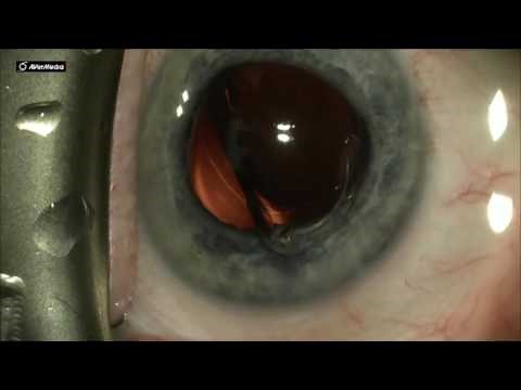 Phacoemulsification: IOL Insertion - 1-Piece Acrylic