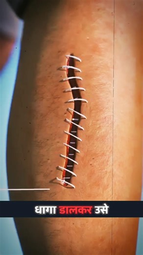 How Stitches Work 😯 | Wound Healing Process Explained in Simple Words #shorts
