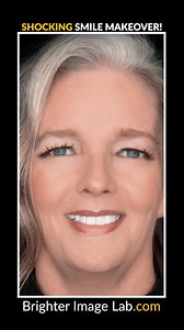 Watch as Ann changes her entire image after wearing her new veneers. She's such a sweet lady and it's an incredible feeling to assist in reclaiming her smile! #BrighterImageLab #BIL #IncrediBIL #Veneers #RemovableVeneers #BILVeneers #SmileGoals #DentalVeneers #SmileMakeover #BrighterSmile #PopOnVeneers #SnapOnSmile #InstaSmile #WhiterTeeth #CosmeticDentistry #PorcelainVeneers #Veneer #SmileBright #StraightTeeth #Braces #AdultBraces #Invisalign #DentalImplants #Dentures #WhiteTeeth #TeethWhitenin