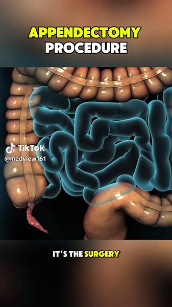 Laproscopic Appendectomy: What to Expect During Surgery