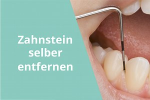 Zahnstein selbst entfernen: So nutzt Du Zahnsteinentferner und Hausmittel