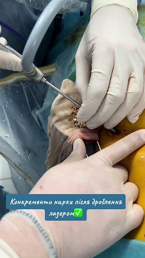 Human Thumb Medical Procedure: Foreign Object Removal
