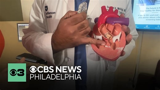 This pacemaker-like device is helping save heart disease patients' lives