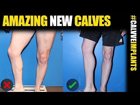 Calf Implants with Male Plastic Surgery Expert Dr. Douglas Steinbrech