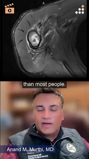 Imaging and Cuff Evaluation in Chronic Shoulder Dislocation