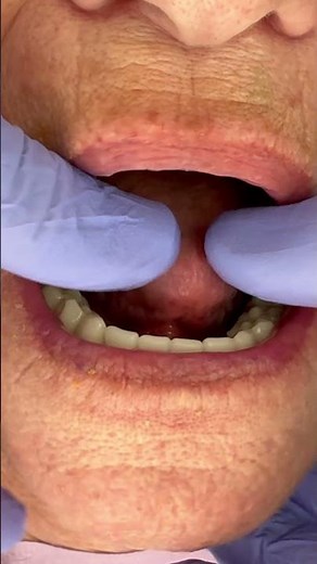 Mastering Mandibular Suction: Live Patient Denture Course Using 3D Printed Bases & Teeth