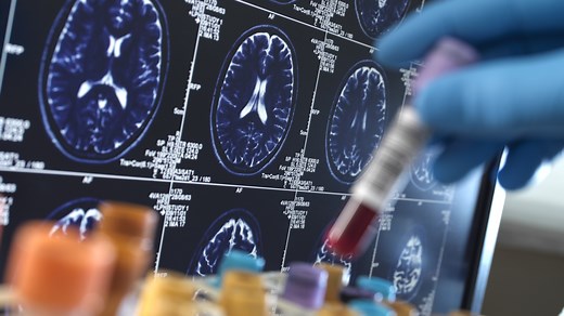 Latest Alzheimer's lab tests focus on memory loss, not brain plaques