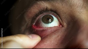 Optician clinic visit. Eye infection, inner stye with pus coming out of it. Swelling eye, cyst.