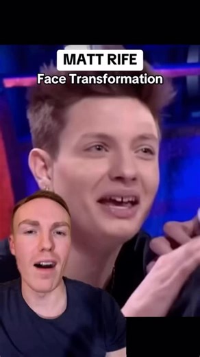 Why do some male faces just look stronger? That jawline. That sharper chin. The cheekbones that actually frame the face. There’s a reason his features changed from soft to sculpted — and it’s not just genetics. 📐 Masculine facial structure is all about balance: ▪️ Jaw-to-cheekbone ratio ▪️ Chin projection ▪️ Width vs height ▪️ Overall “robusticity” (yep, it’s a real term) And no — it’s not just for models or actors. Understanding your facial blueprint can open the door to subtle changes that br