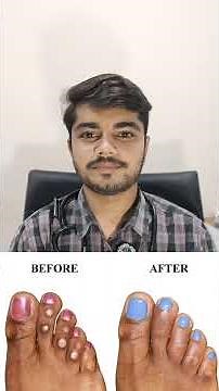 “Get rid of corns fast! 👣 Home remedies & tips for pain-free feet. #CornsTreatment #homeopathy