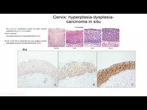 Pathology Made Easy 5- Neoplasia 1- General Features of Neoplasia