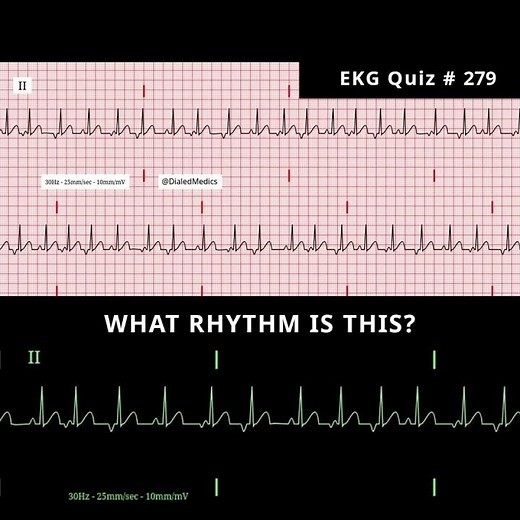 Test Your EKG Skills ⚡ Guess the Rhythm!