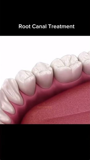 Root Canal #dubai #shorts #viral #reels #dental