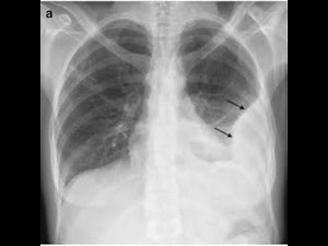 Pleural effusion diagnosis, workup and management.(Harrison's guidelines included).