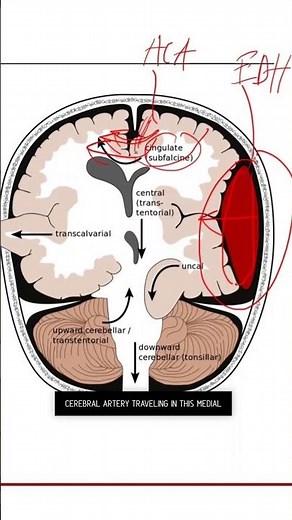 Subfalcine Herniation and Transtentorial Herniation Explaine