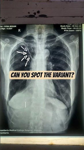 Can You Solve This Chest X-Ray Puzzle? Looks Abnormal but Completely Normal!
